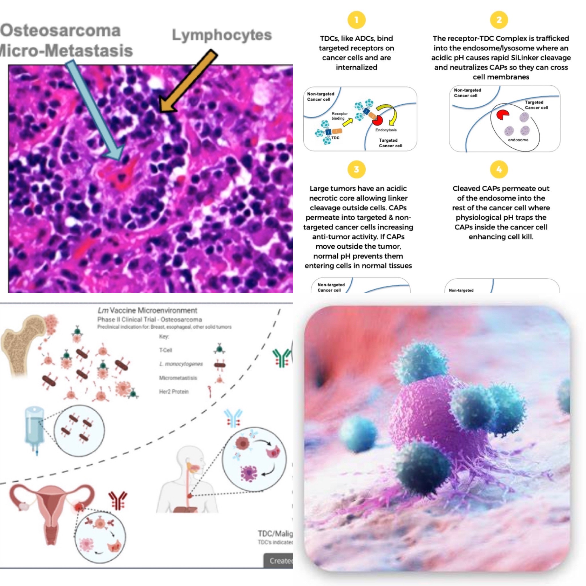 Fighting Osteosarcoma in Children, Stage 2 Research and Breakthroughs ...